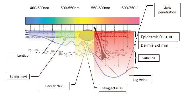 [ 피부미용 ] IPL(intense pulsed light)이란? - 석촌동, 송파동, 가락동 헬리오시티피부과 : 네이버 블로그