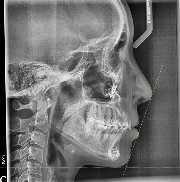얼굴에서 입술 지지의 중요성 (lip support) : 네이버 블로그