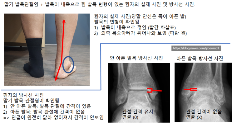 발목 인공 관절 수술의 실제 과정 및 결과 발목이 내측으로 휘면서 붓고 아파요 발목 변형과 말기 발목 관절염의 수술적