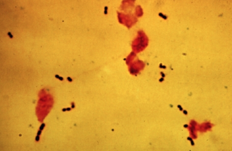 소아 뇌수막염에서 그람 염색과 특징, Gram stain, characteristic features, bacterial ...