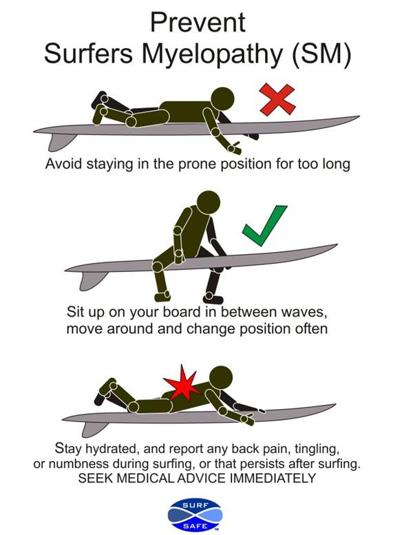 서핑 척수병(희귀병) Surfer’s myelopathy : 네이버 블로그