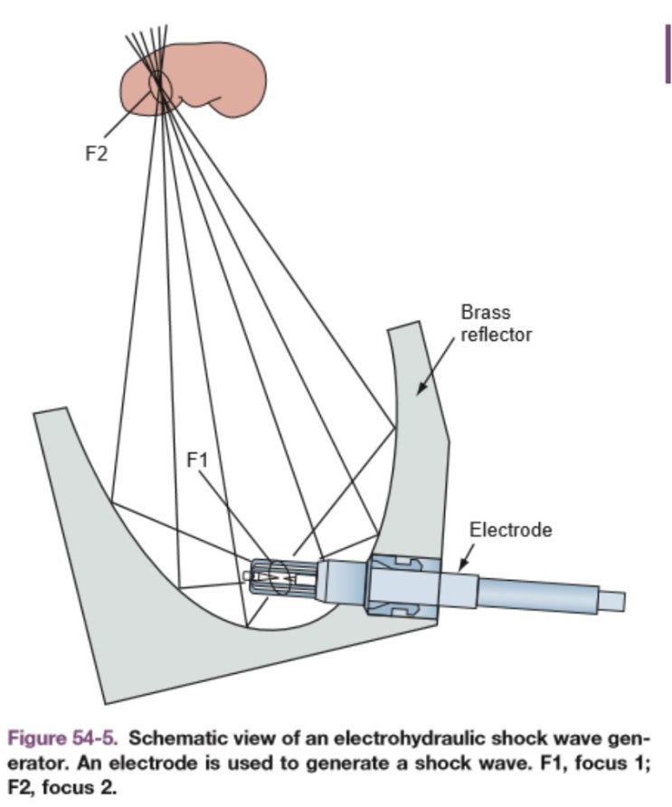 요로 결석 치료 ESWL 기계의 종류 - Extracorporeal Shockwave Lithotripsy, Types of ...