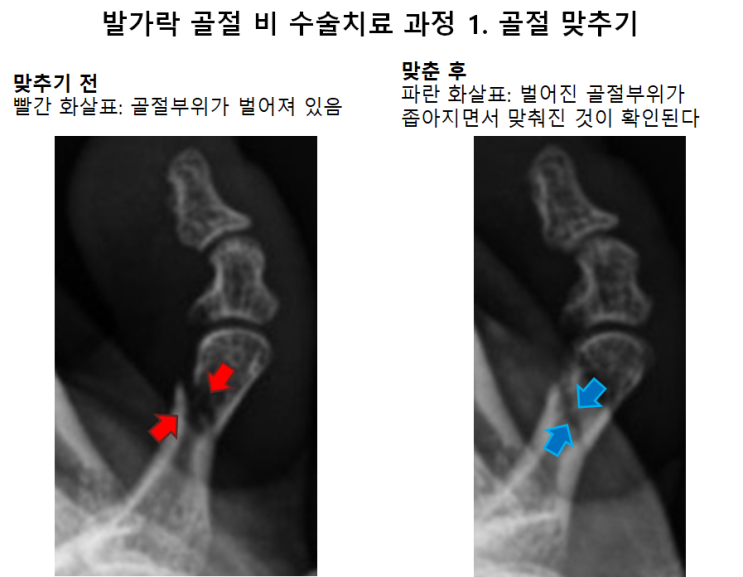 발가락 골절1 발가락을 다친 후 발가락 통증이 있으면서 발가락이 붓고 멍 들었어요 발가락 골절의 원인 증상 진단 및
