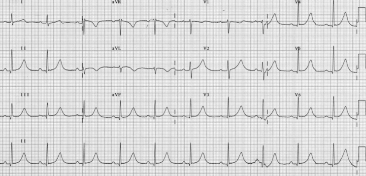 조기재분극증후군(Early repolarization syndrome) 심전도(ECG) 소견 : 네이버 블로그
