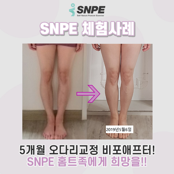 [SNPE 체험사례] 홈트족 필독!! 오다리교정 5개월 비포애프터, 통증완화까지! : 네이버 블로그