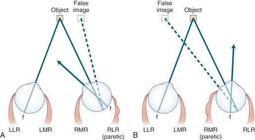 [복시/Diplopia] #2. 복시의 진단·검사 : 네이버 블로그