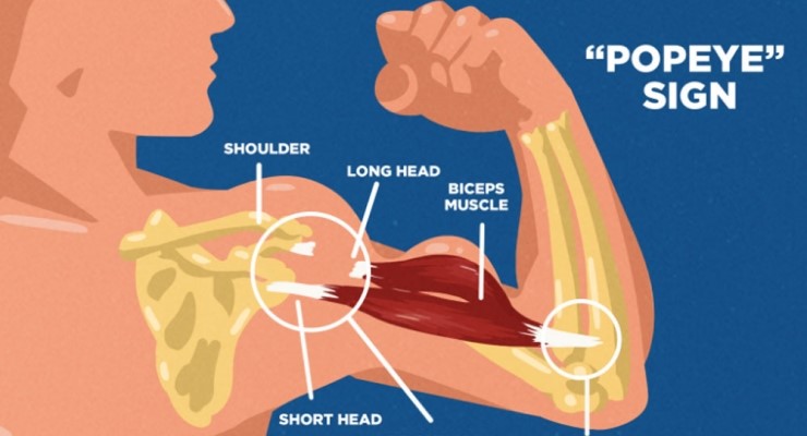 이두근 손상으로 인한 뽀빠이 증상(popeye sign). : 네이버 블로그