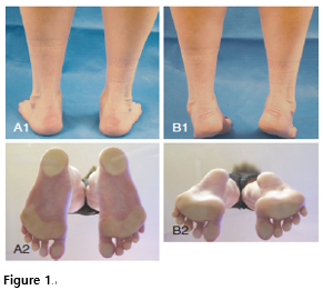 족부 압력 검사의 임상적 응응(Pedobarograph) : 네이버 블로그