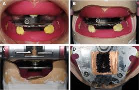 안면(하악)비대칭 교정 고딕아치 CENTROFIX 임상 정복! : 네이버 블로그