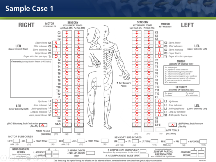 ISNCSCI 쉽게 이해하기(ASIA scale) - #5 Sample case : 네이버 블로그