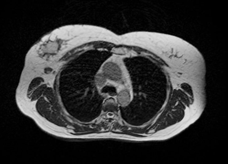 ViewRay MRIdian Linac (뷰레이)이란? : 네이버 블로그