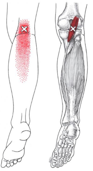 족척근 통증유발점(Plantaris Trigger Point), 오금부에서 종아리 아래로 내려오는 통증. : 네이버 블로그