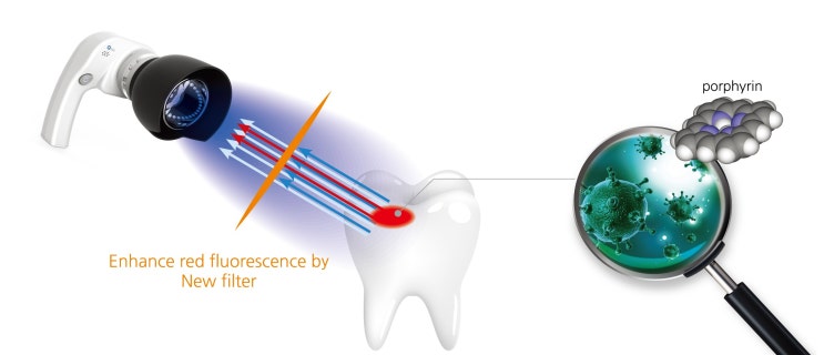 《큐레이펜_QRaypen》 ① 스마트한 충치 진단 카메라_초기우식검사_[헬리오시티 어린이치과/소아치과] : 네이버 블로그