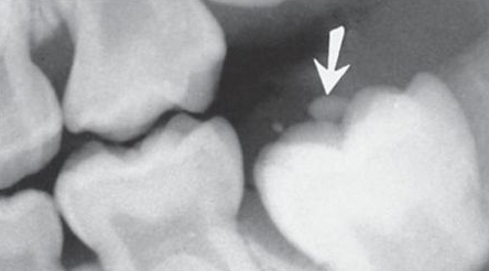 새로 나온 어금니가 깨졌어요! 맹출성 부골(Eruption sequestrum), 어금니 위에 이 뼈조각? 치아조각?은 무엇인가 ...
