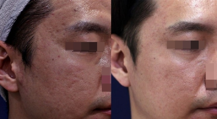 여드름 흉터 Dna 흉터재생술진피재생술 피부과 레이저 3회 치료 후기 레이져 전후 사진 네이버 블로그