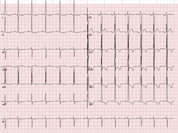 Hypertrophic cardiomyopathy, LVH ECG : 네이버 블로그