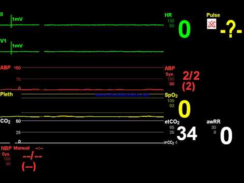 DC cardioversion : 네이버 블로그