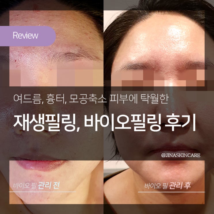알라딘필링 바이오필링등 여드름흉터 모공관리에 좋은 재생필링의 모든 것 네이버 블로그