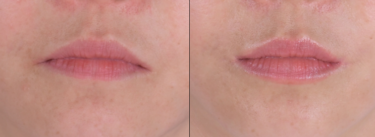 [Eng.]Smile Lipt®(Mouth Corner Lift) : 네이버 블로그