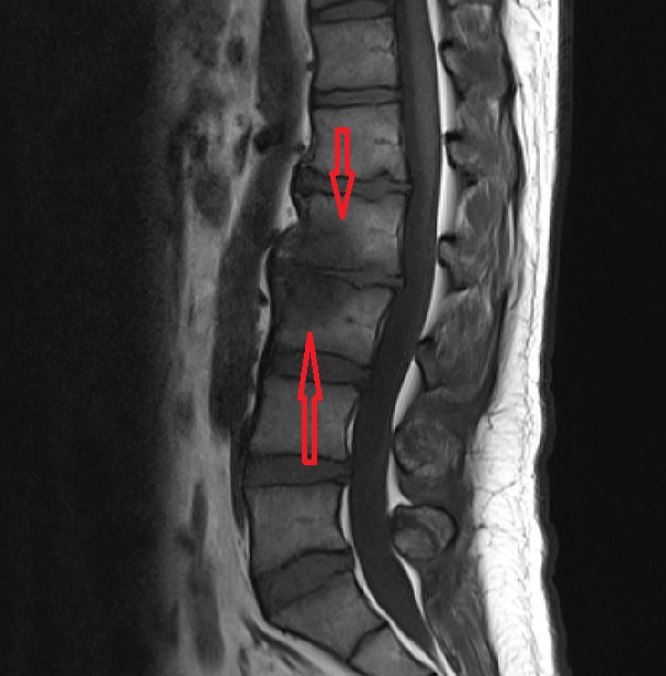 척추에서의 Modic change(모딕 변화) 원인 : 네이버 블로그