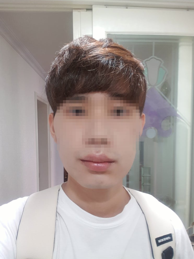 남자 양악수술 후기 23일차 네이버 블로그