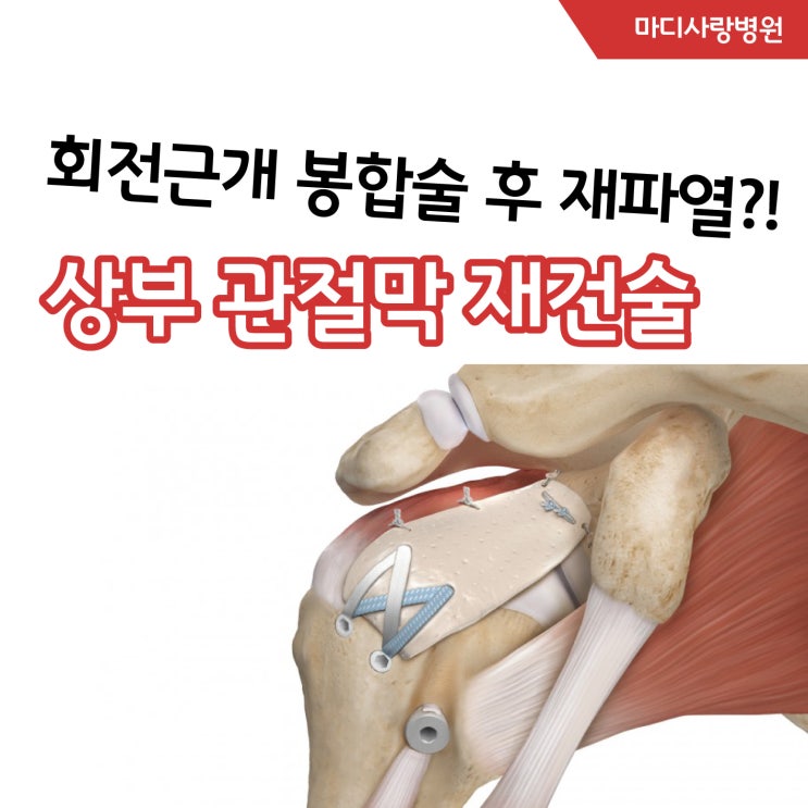 회전근개 봉합술 후 재파열 상부 관절막 재건술 청주 정형외과청주 재활 마디사랑병원 네이버 블로그