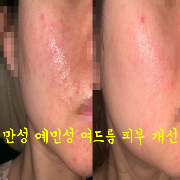 예작화장품 예민성 민감성 만성 여드름 피부 And 여드름 개선 And 스테로이드 부작용 개선 네이버 블로그