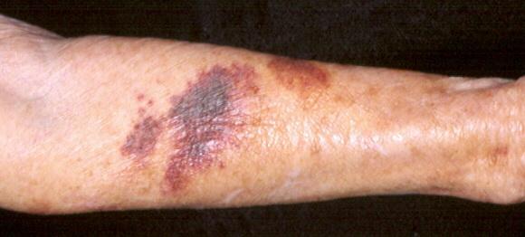 노인성 자반증(senile purpura) 또는 일광 자반증(actinic purpura) by 아는의사 : 네이버 블로그