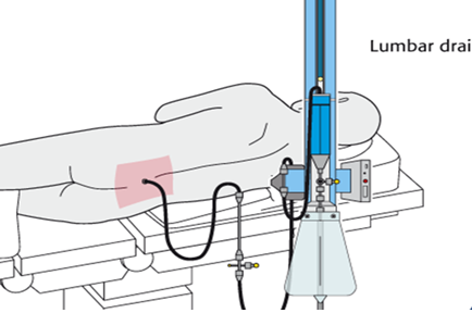 Lumbar drainage; 요추배액 : 네이버 블로그