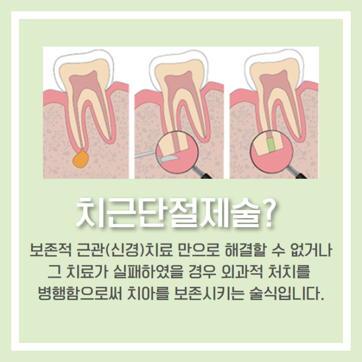 미세현미경을 이용한 치근단절제술이란 치근단절제술실제치료사례 반드시 미세현미경을 사용해야하는 이유 네이버 블로그