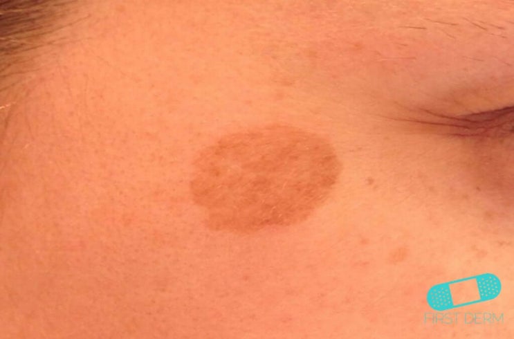 흑자 Lentigo simplex : 네이버 블로그