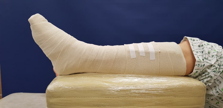 Short Leg Dorsal Splint Type : 네이버 블로그