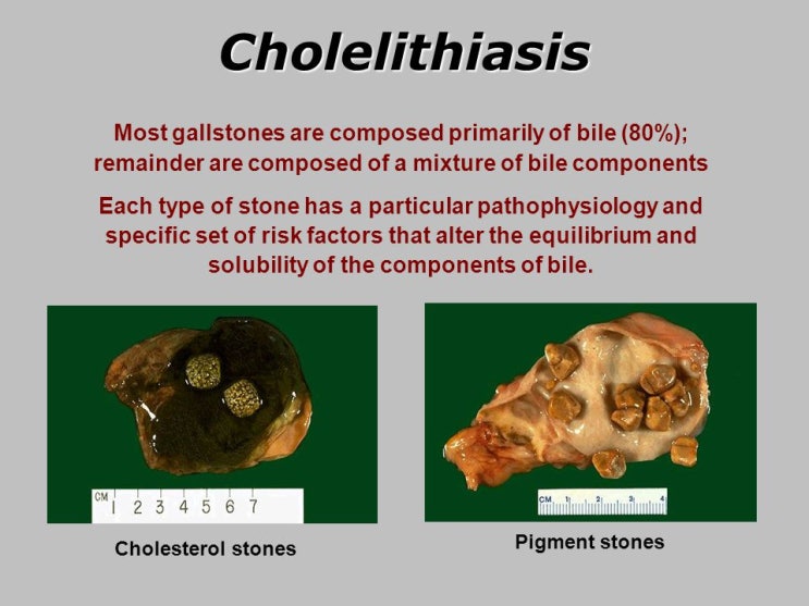 담석증(cholelithiasis)요약. : 네이버 블로그