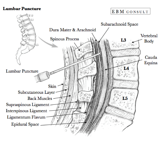 Spinal tapping (Lumbar puncture) : 네이버 블로그