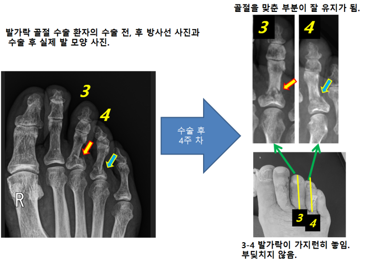 발가락 골절의 실제 수술 사례 발가락 골절 후 발가락이 휘어져서 수술을 해야한다구요 세번째 네번째 발가락 골절의 수술적