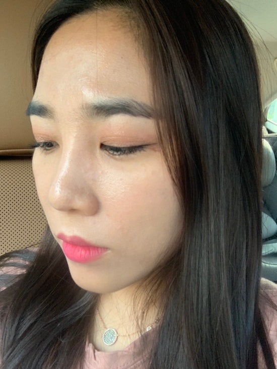 리쥬란힐러 2cc 2주 후 변화/연어주사 리얼 후기 2차 포스팅(예뻐지려면 노력해야해요.) : 네이버 블로그