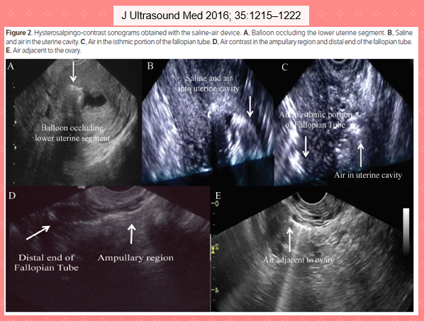 나팔관 초음파 검사(자궁난관 조영초음파 HyCoSy)와 나팔관 조영술(HSG) 통증, 정확도, 임신 결과 차이점 / 비교 정리 ...