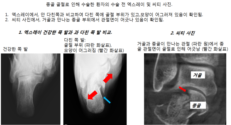 발 뒤꿈치 뼈 골절 종골 골절의 수술 실제 사례 높은 곳에서 떨어진 후 발 뒤꿈치 뼈가 아프고 부었어요 종골 골절의 정복