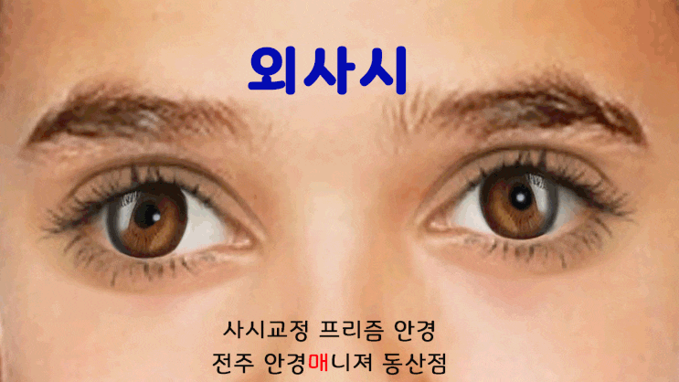전주 성인사시】 눈이 돌아가는 40대 여성 외사시 교정 프리즘 안경으로 불편 증상 해결 네이버 블로그