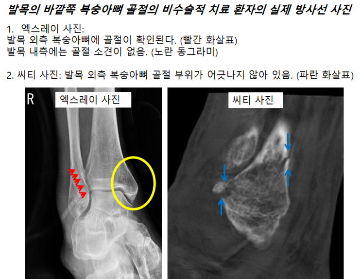 발목 비골 골절의 비수술 치료 사례 발목을 접질렀는데 발목 바깥쪽 복숭아뼈 골절이라구요 발목 외과 골절 비 수술 재활 과정