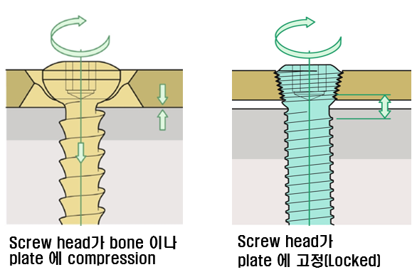 ORIF(open reduction internal fixation) 기본 : 네이버 블로그