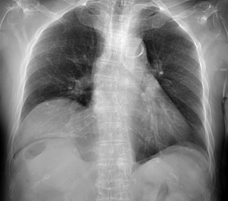 [CXR] Calcification of Aorta : 네이버 블로그