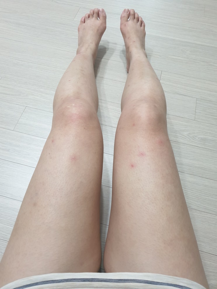 190828사이폴엔 증량스테로이드 끊음분당서울대병원 4번째외래두드러기피부염모낭염스테로이드 부작용크레오신씨잘정