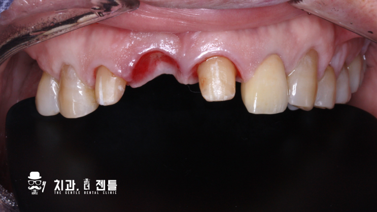 [잇몸 / 흔들리는 앞니 발치] 치주염으로 앞니를 발치한 환자분의 잇몸뼈 이식을 동반한 Ovate pontic 브릿지 치료 증례 ...