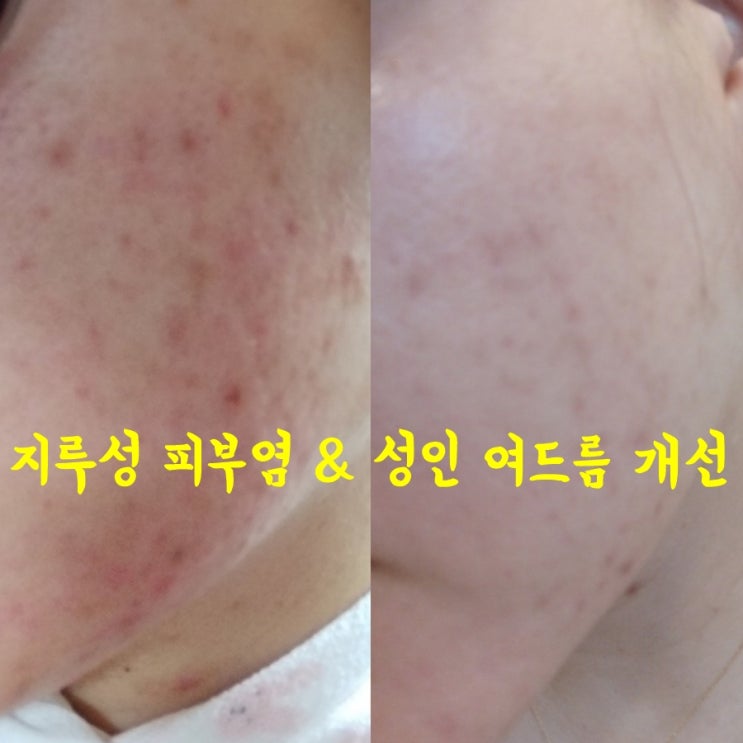 예작화장품 지루성 피부염 And 성인 여드름 And 턱 트러블 올바르게 빠르게 개선 네이버 블로그