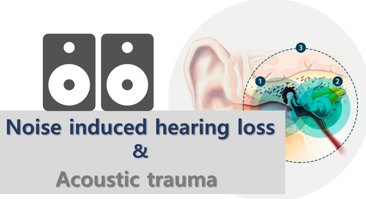 Noise induced hearing loss 소음난청(소음성난청) & Acoustic trauma 음향외상 : 네이버 블로그