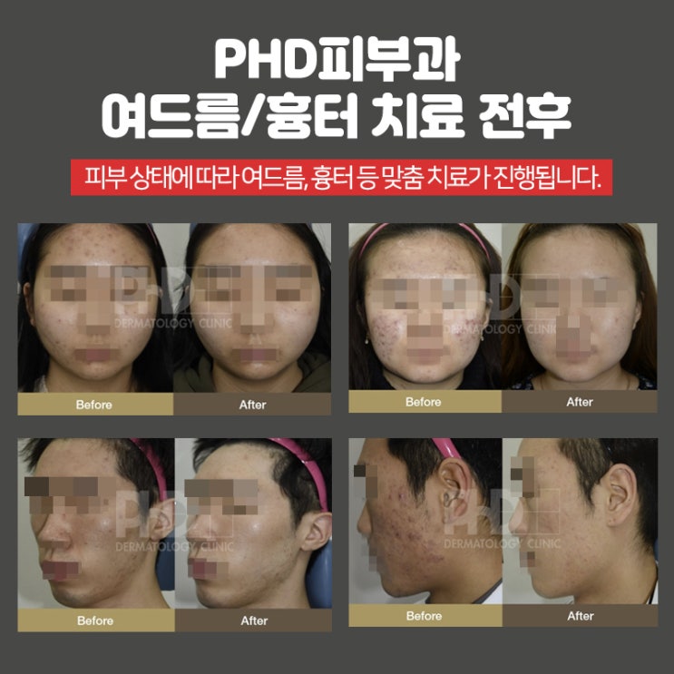 동대문 여드름치료 Pdt 추천 비용 피지관리 여드름균 청소년여드름 성인여드름 피부트러블 스킨 스케일링 Phd피부과 네이버 블로그