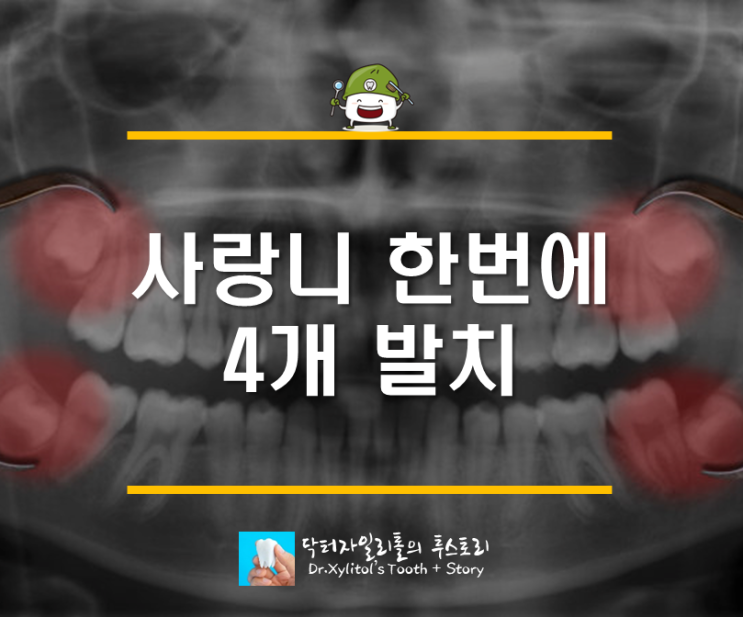 사랑니 한번에 4개 발치 가능한가요 하악 상악 사랑니 양쪽 발치 발치 과정 비용 수면마취 By 닥터자일리톨