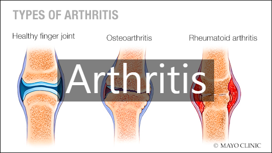 26. Amputation, Fracture, Crutch, Rheumatoid arthritis vs Osteo ...