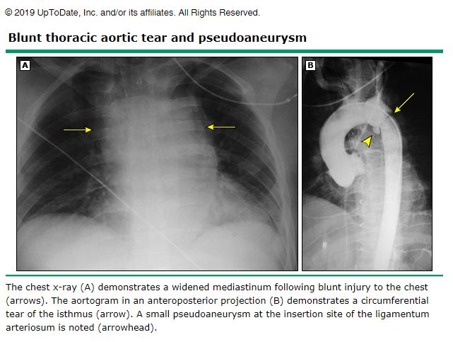 Blunt thoracic aortic injury case : 네이버 블로그